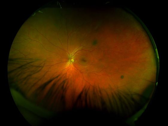 Digital Retinal Photography | Vision North Eyecare